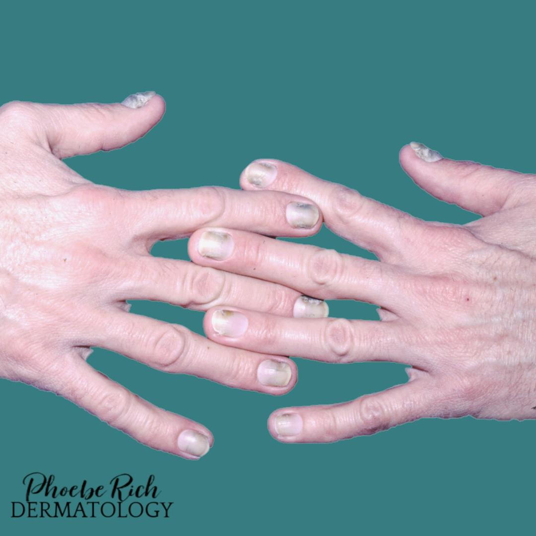 6 Nail Symptoms That Shouldn't Be Ignored - Phoebe Rich, MD