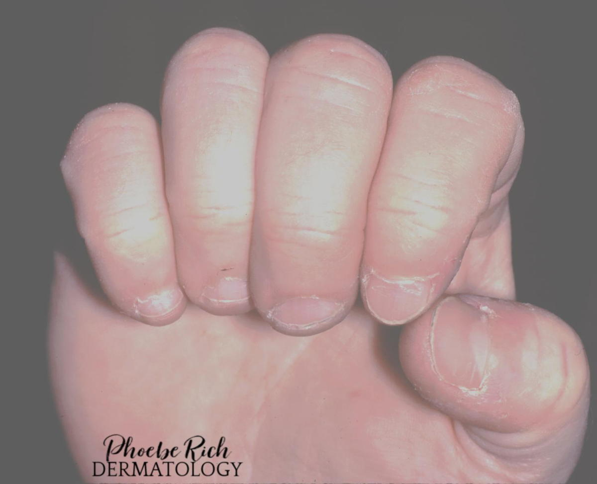 6 Nail Symptoms That Shouldn't Be Ignored - Phoebe Rich, MD